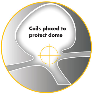 Neqstent™ Coil Assisted Flow Diverter | Stryker